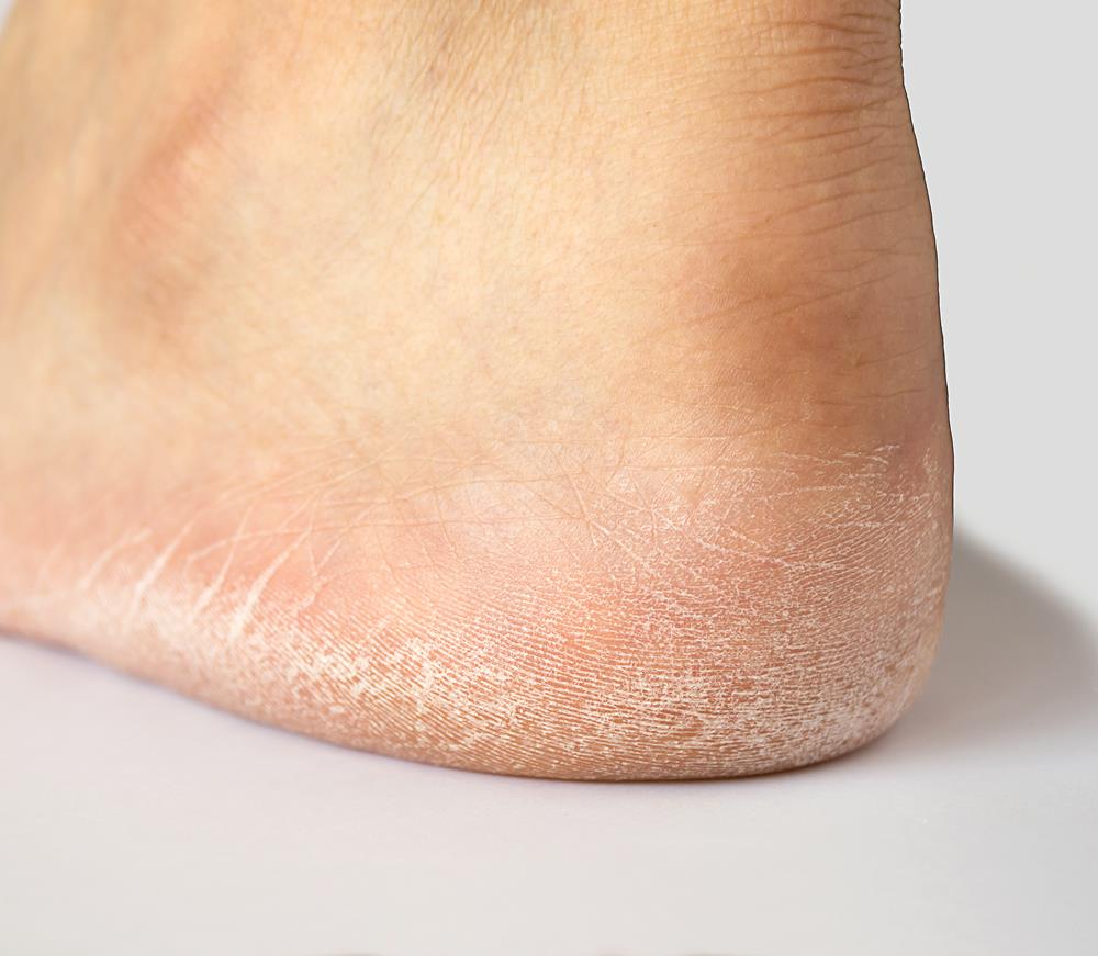 Flat Feet Treatment in Shillington & Hamburg, PA | Berks Foot & Ankle ...